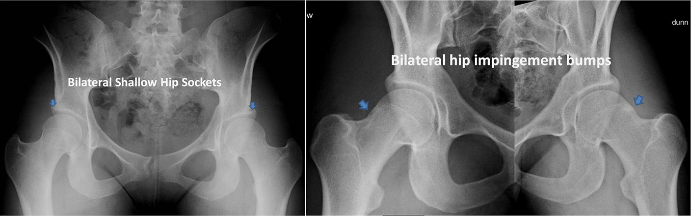 Hip Dysplasia Pao – Periacetabular Osteotomy (PAO) Hip Surgery in Kids ...
