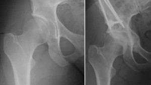 Periacetabular Osteotomy (PAO) for Acetabular Dysplasia - John C ...